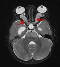 Neurofibromatose chez l'enfant | CHU Sainte-Justine
